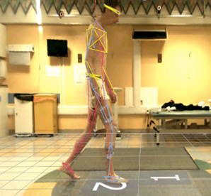 Functional Muscle Transfer Surgery for Sarcoma Patients | Beatson ...